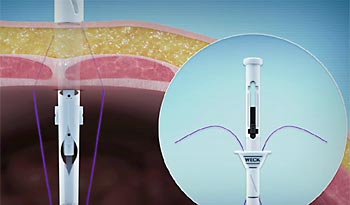 Weck™ EFX Shield™ | Canada | Teleflex