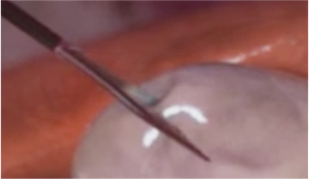 MiniLap™ System | Canada | Teleflex